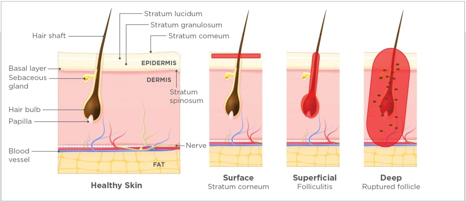 Superficial bacterial pyoderma in dogs - VSL Veterinary Clinic